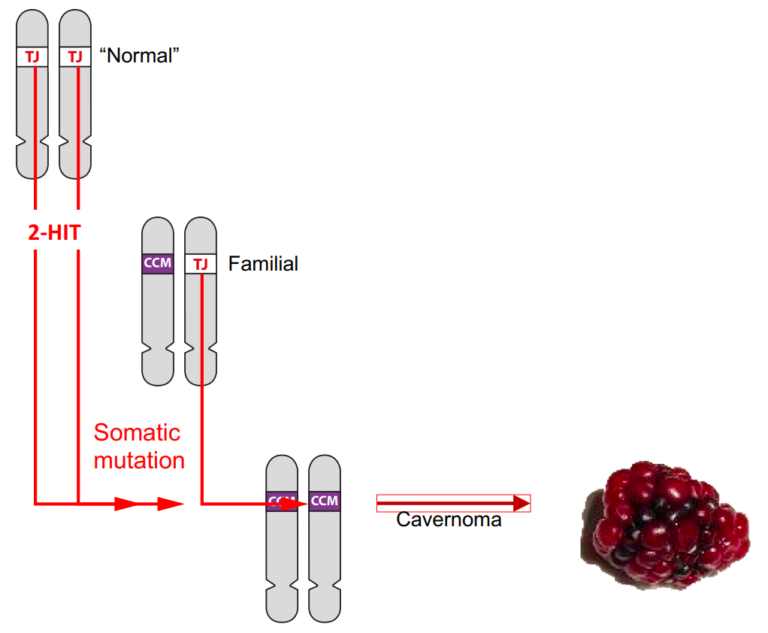 How Cavernoma are formed and develop (Part 5) - Cavernoma Alliance UK ...