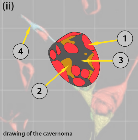 How Cavernoma are formed and develop (Part 5) - Cavernoma Alliance UK ...