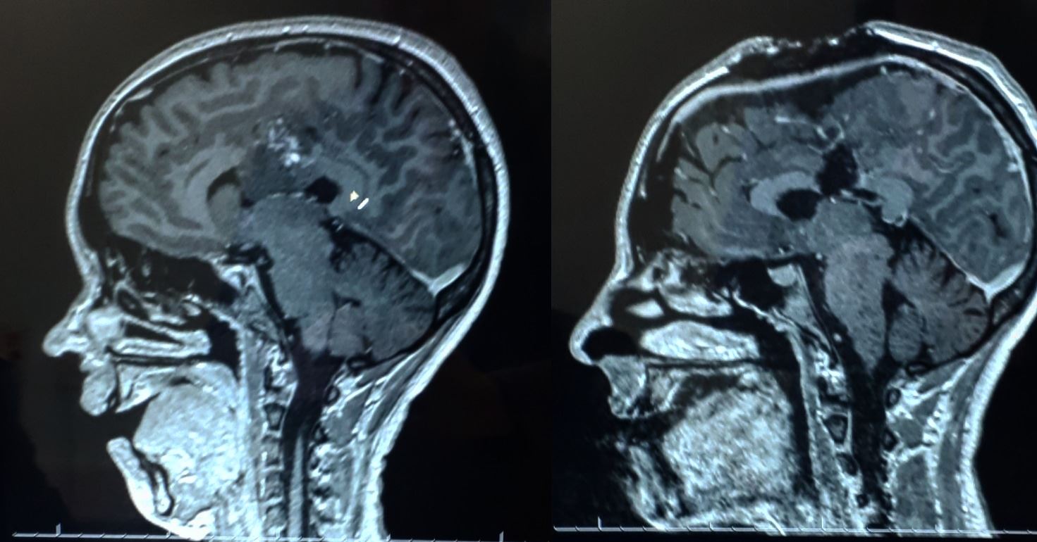 Let's Talk Cavernoma - Bleeding & Strokes Explained with Daniel Walsh ...